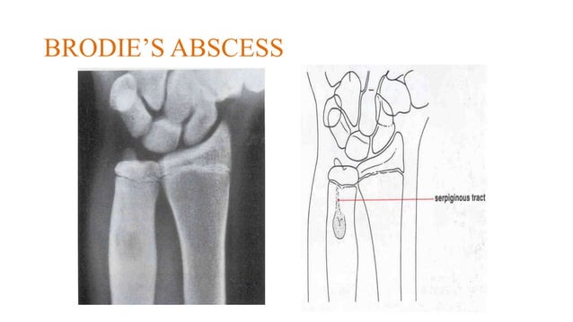 Imaging in infections of bones and joints2.pptx