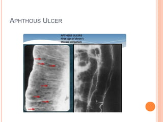Imaging in Inflammatory Bowel Disease | PPTX
