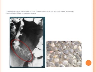 Imaging in Inflammatory Bowel Disease | PPTX