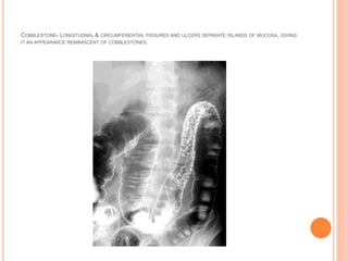 Imaging in Inflammatory Bowel Disease | PPTX