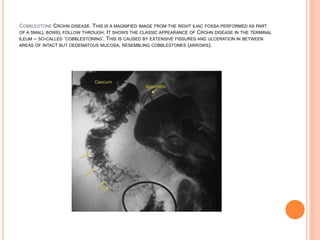 Imaging in Inflammatory Bowel Disease | PPTX