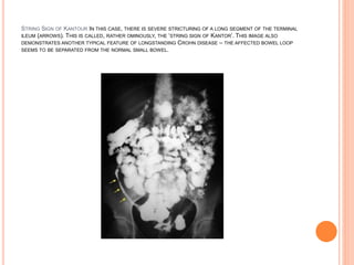 Imaging in Inflammatory Bowel Disease | PPTX