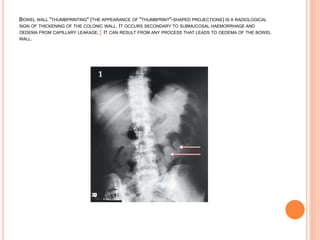 Thumbprint Sign Bowel
