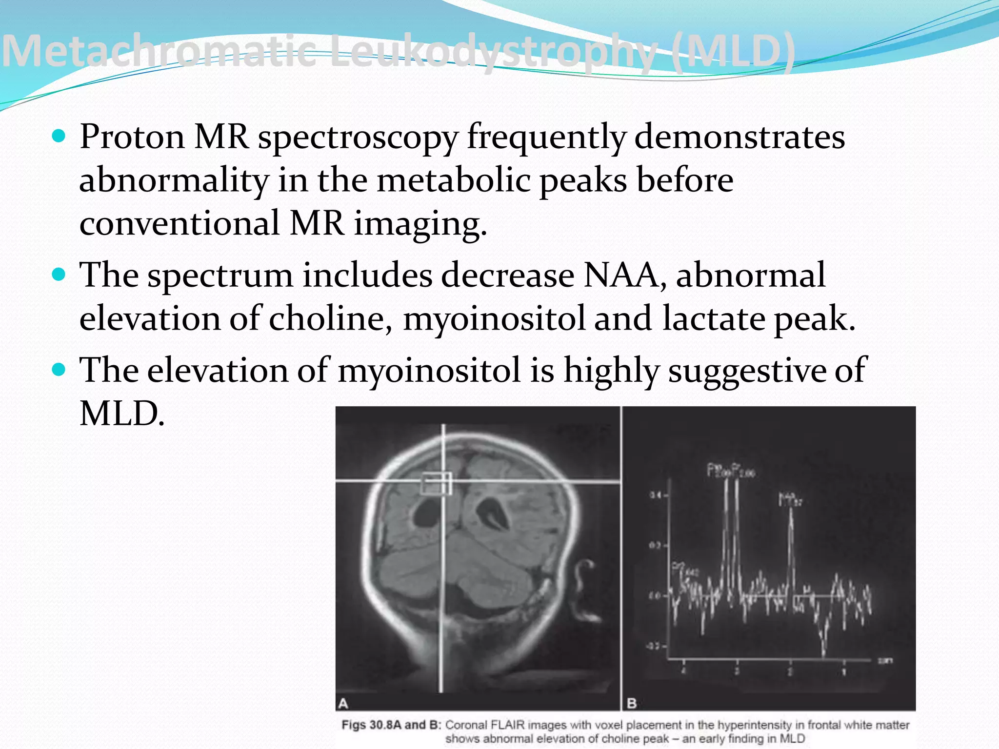 Imaging in inherited metabolic disorders | PPTX