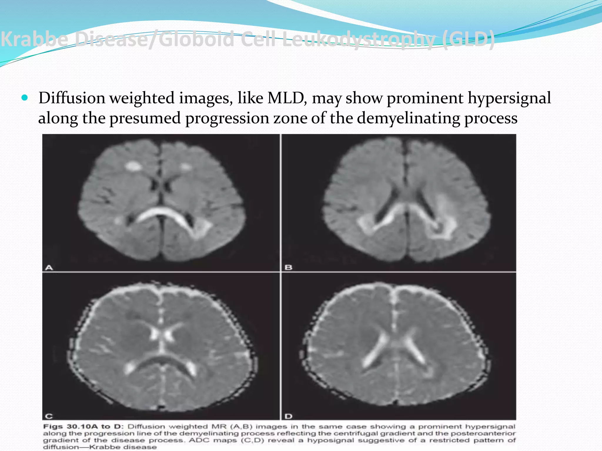 Imaging in inherited metabolic disorders | PPTX