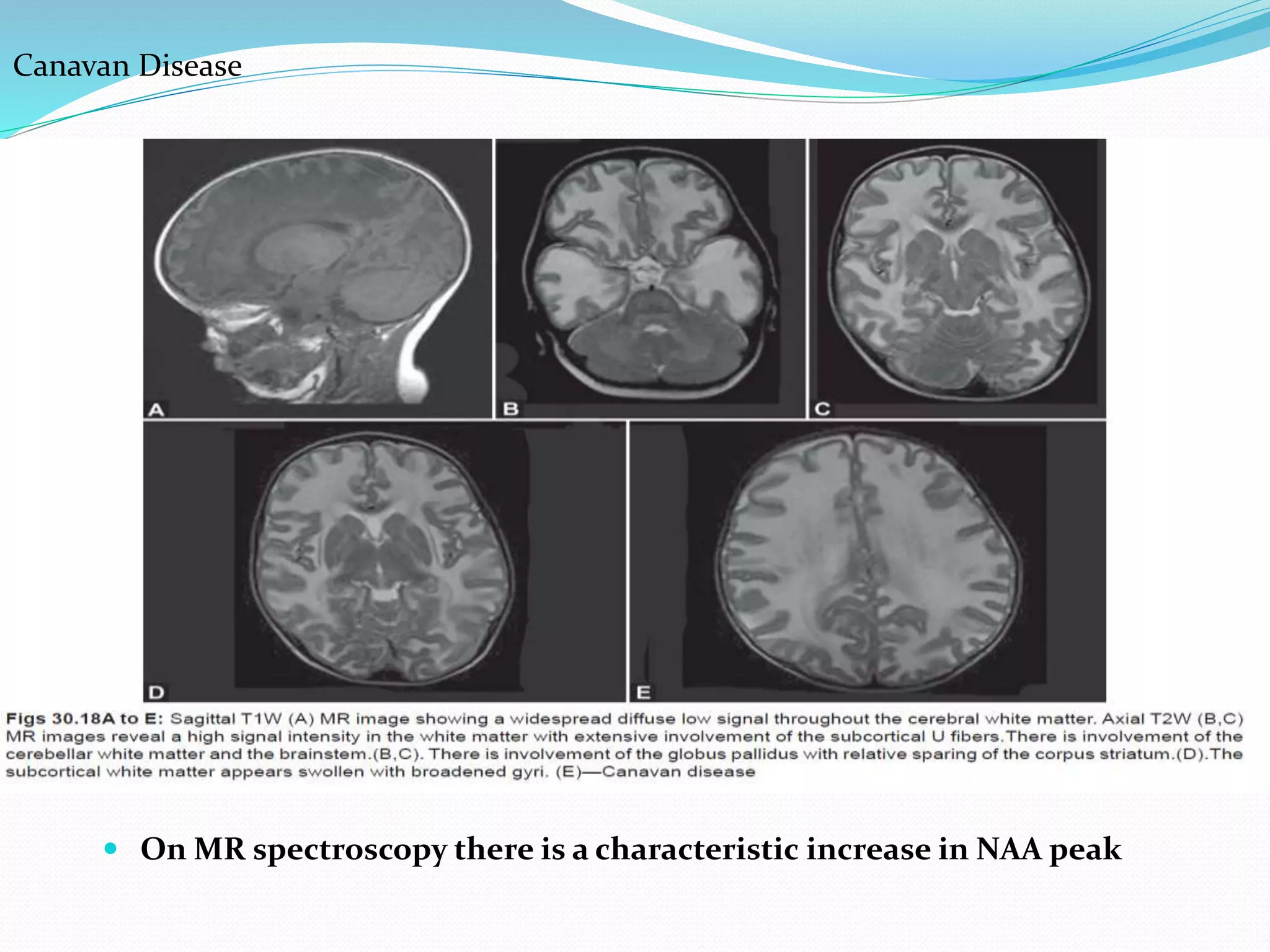 Imaging in inherited metabolic disorders | PPTX
