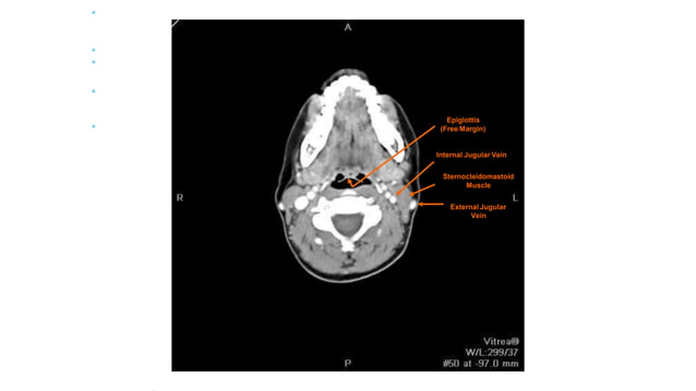 Imaging in laryngeal malignancy | PPTX | Thyroid Disorders | Endocrine ...