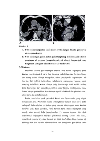 Imaging in lung fungal infection | PDF