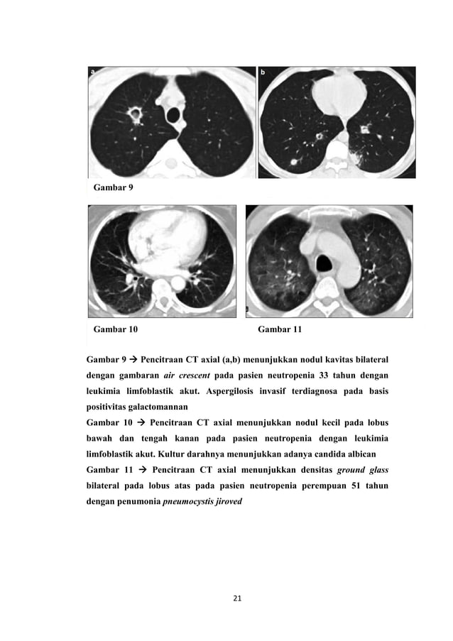 Imaging in lung fungal infection | PDF