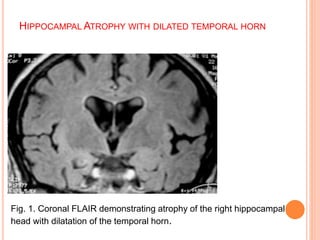 Imaging in MESIAL TEMPORAL EPILESPY | PPTX