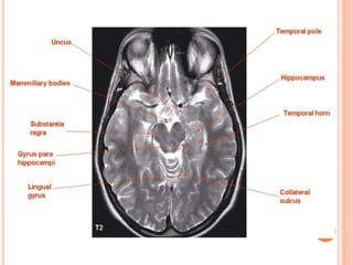 Mesial Temporal Lobe Anatomy
