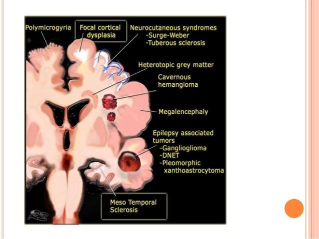 Imaging in MESIAL TEMPORAL EPILESPY