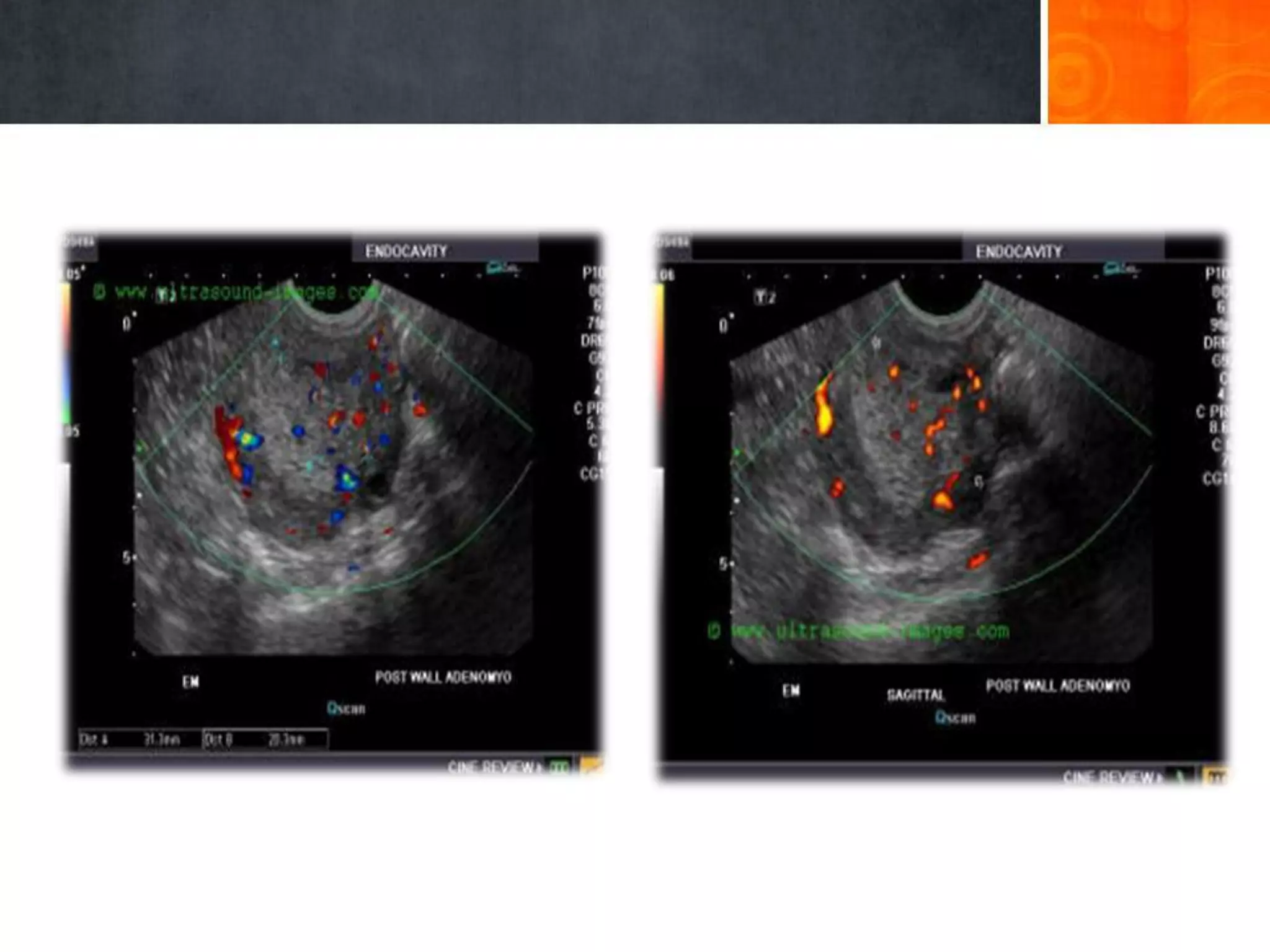 Imaging in obstetrics & gynaecology (part 1- Gynaecological scans in ...