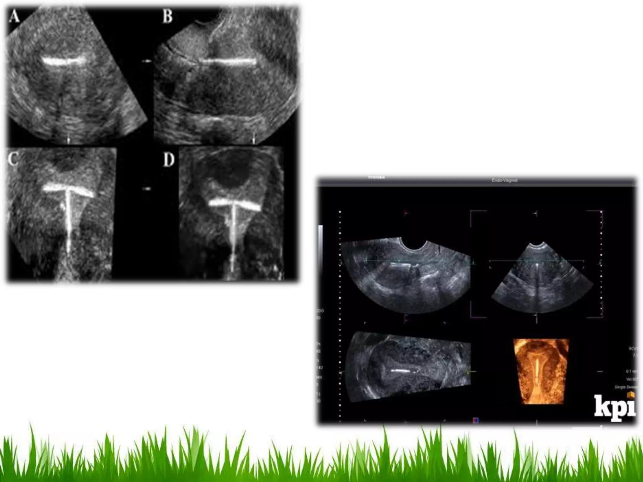Imaging in obstetrics & gynaecology (part 1- Gynaecological scans in ...