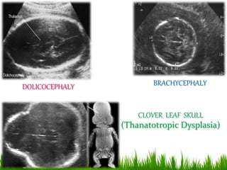 Cloverleaf Skull Ultrasound