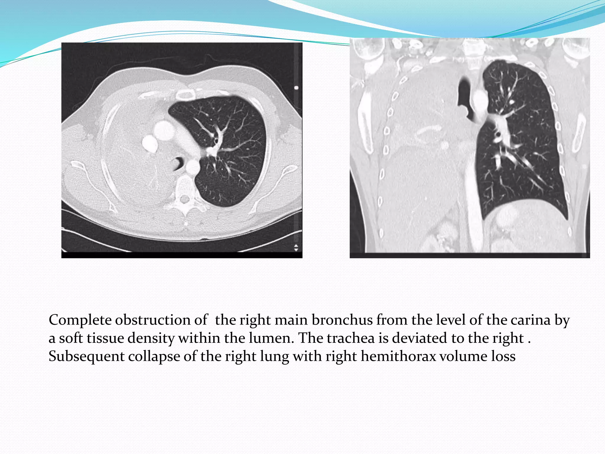 Imaging in opaqe hemithorax [autosaved] | PPTX