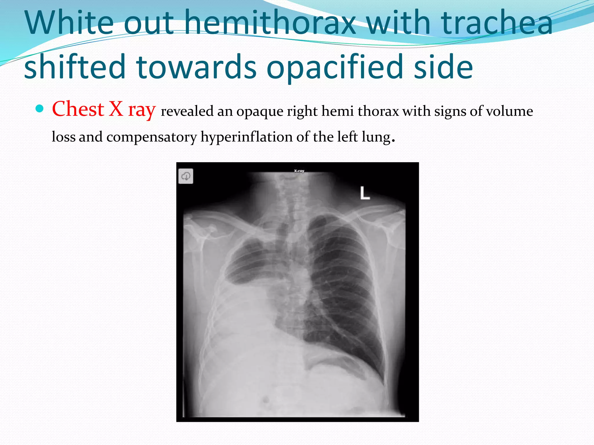 Imaging in opaqe hemithorax [autosaved] | PPTX