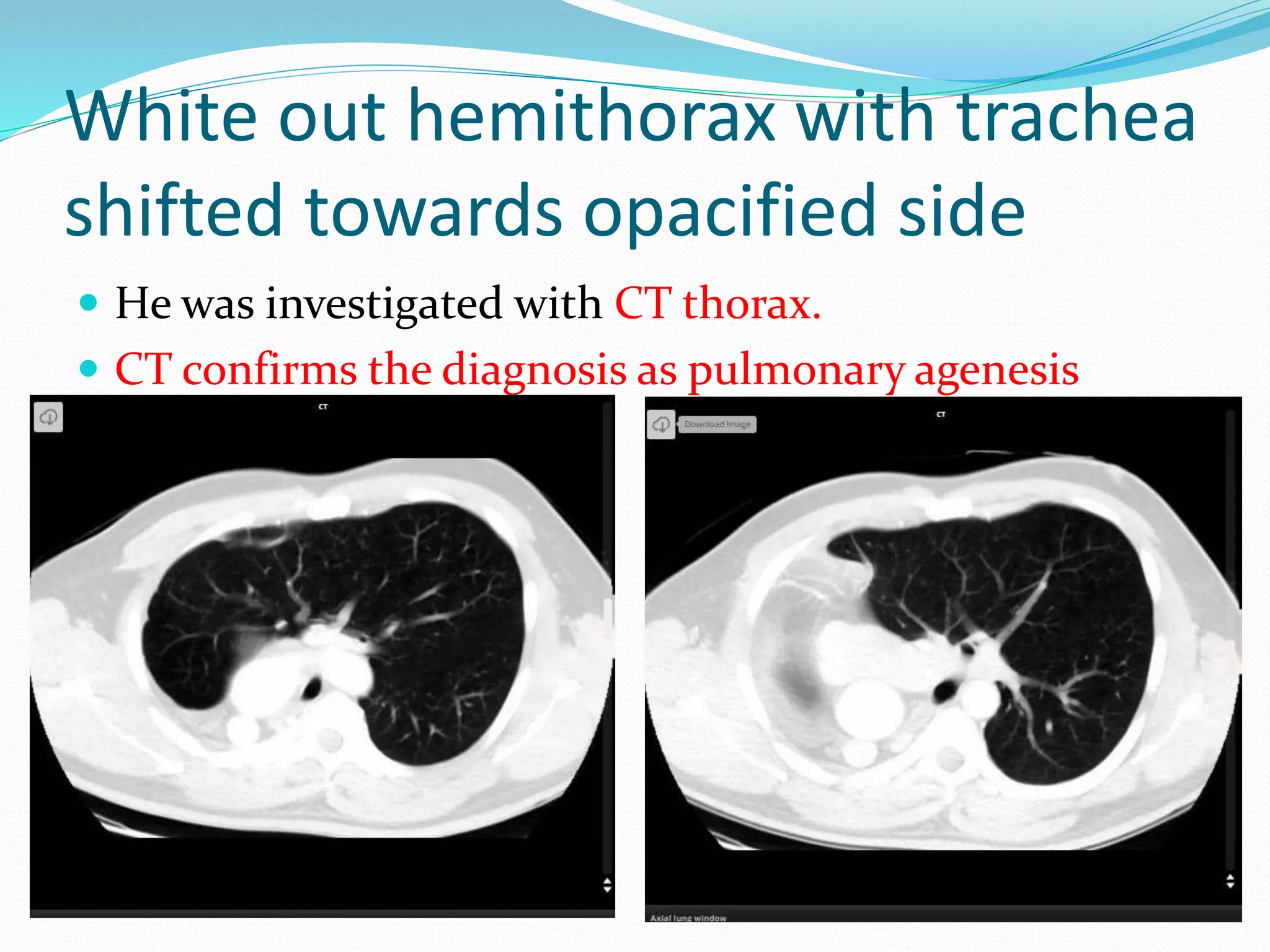 Imaging in opaqe hemithorax [autosaved] | PPTX