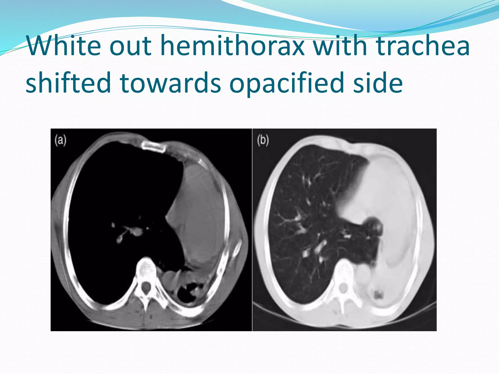 Imaging in opaqe hemithorax [autosaved] | PPTX