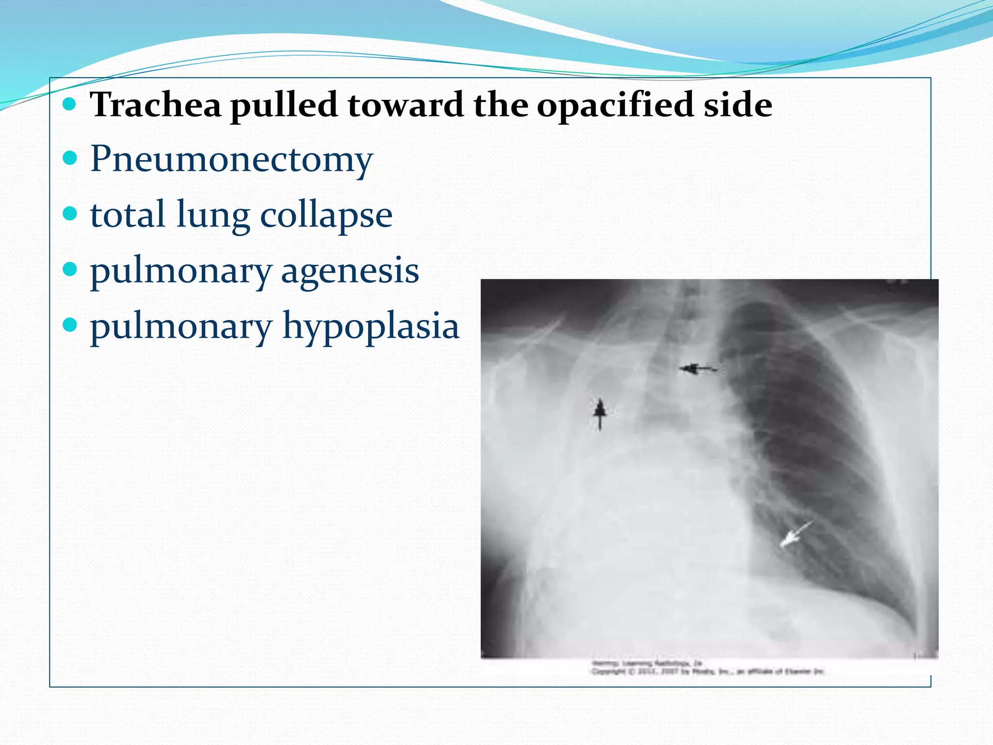 Imaging in opaqe hemithorax [autosaved] | PPTX