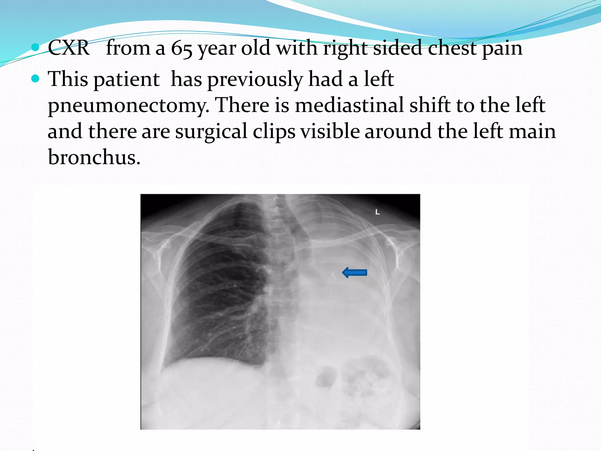 Imaging in opaqe hemithorax [autosaved] | PPTX