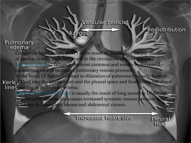 Imaging in opaqe hemithorax [autosaved] | PPTX