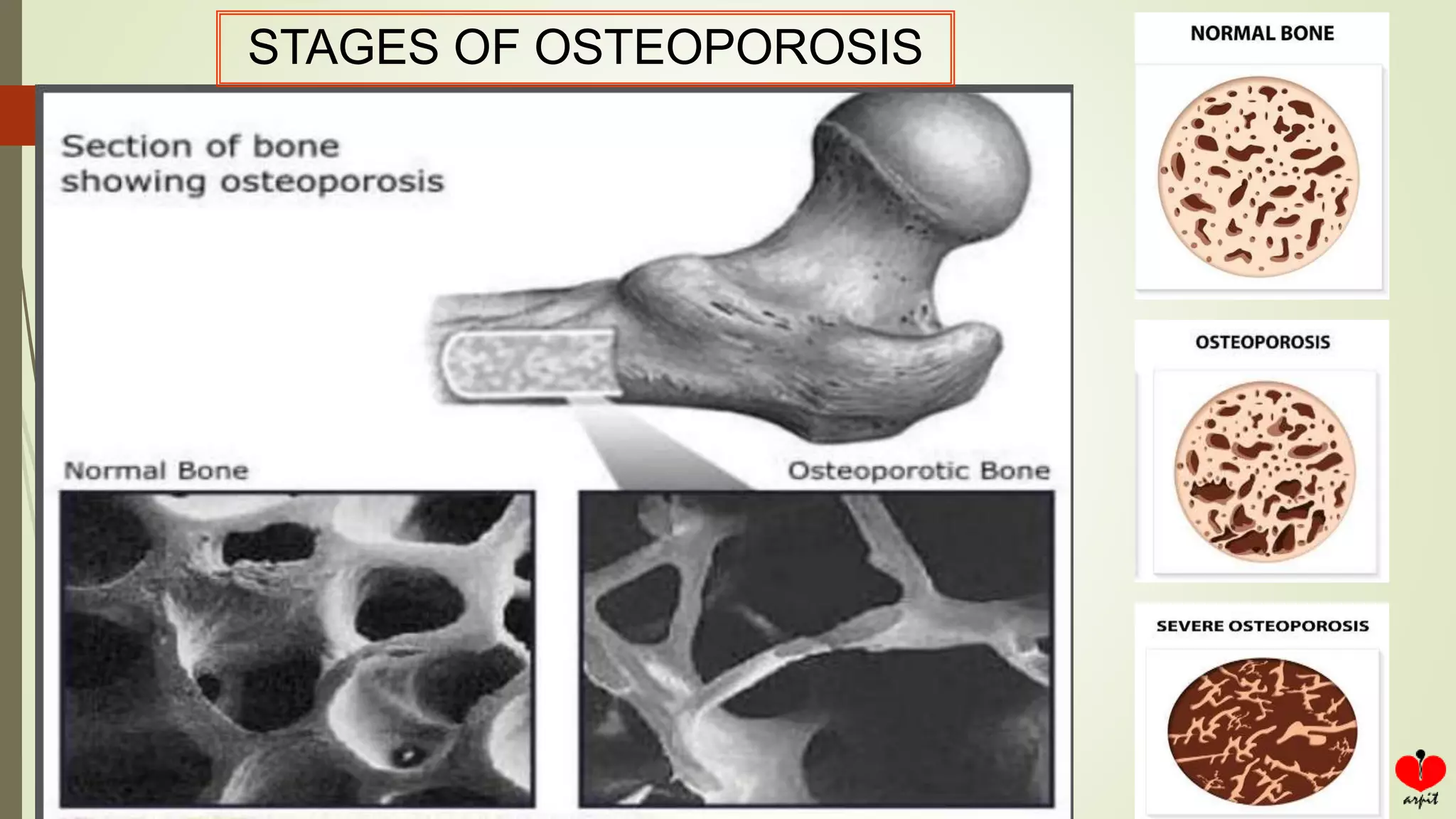 IMAGING IN OSTEOPOROSIS.pptx
