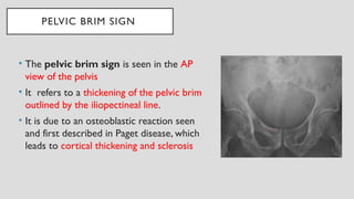 IMAGING IN PAGETS DISEASE OF BONE........pptx