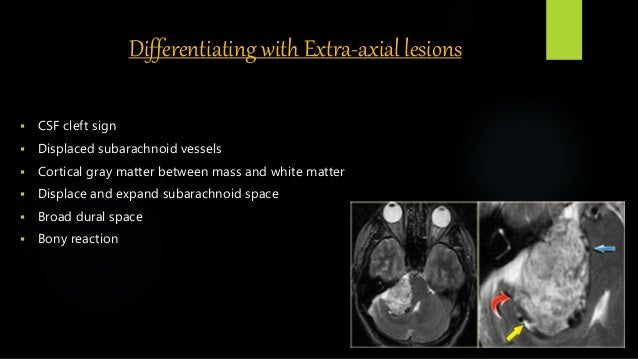 Imaging in pediatric brain tumors