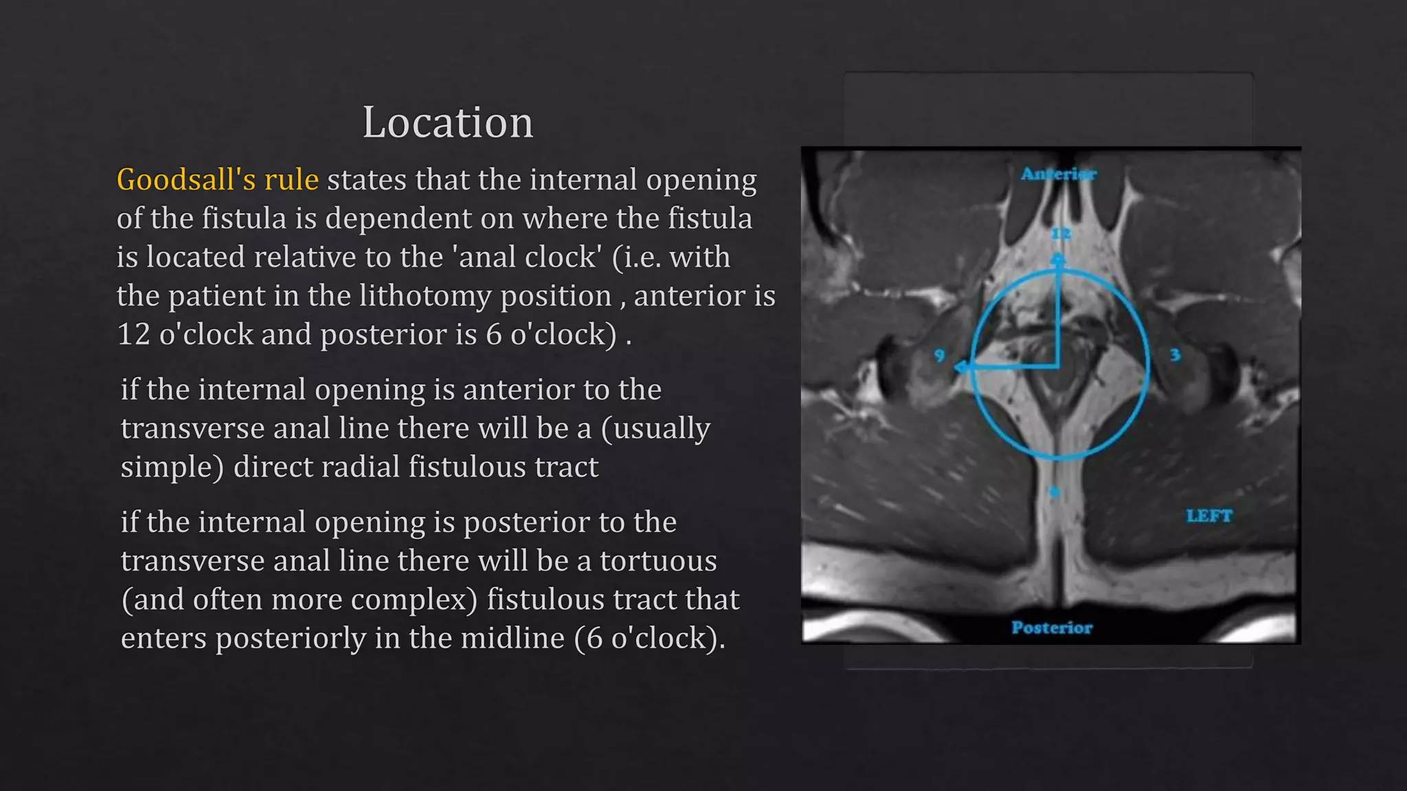 Radiological Imaging in perianal fistula | PPTX