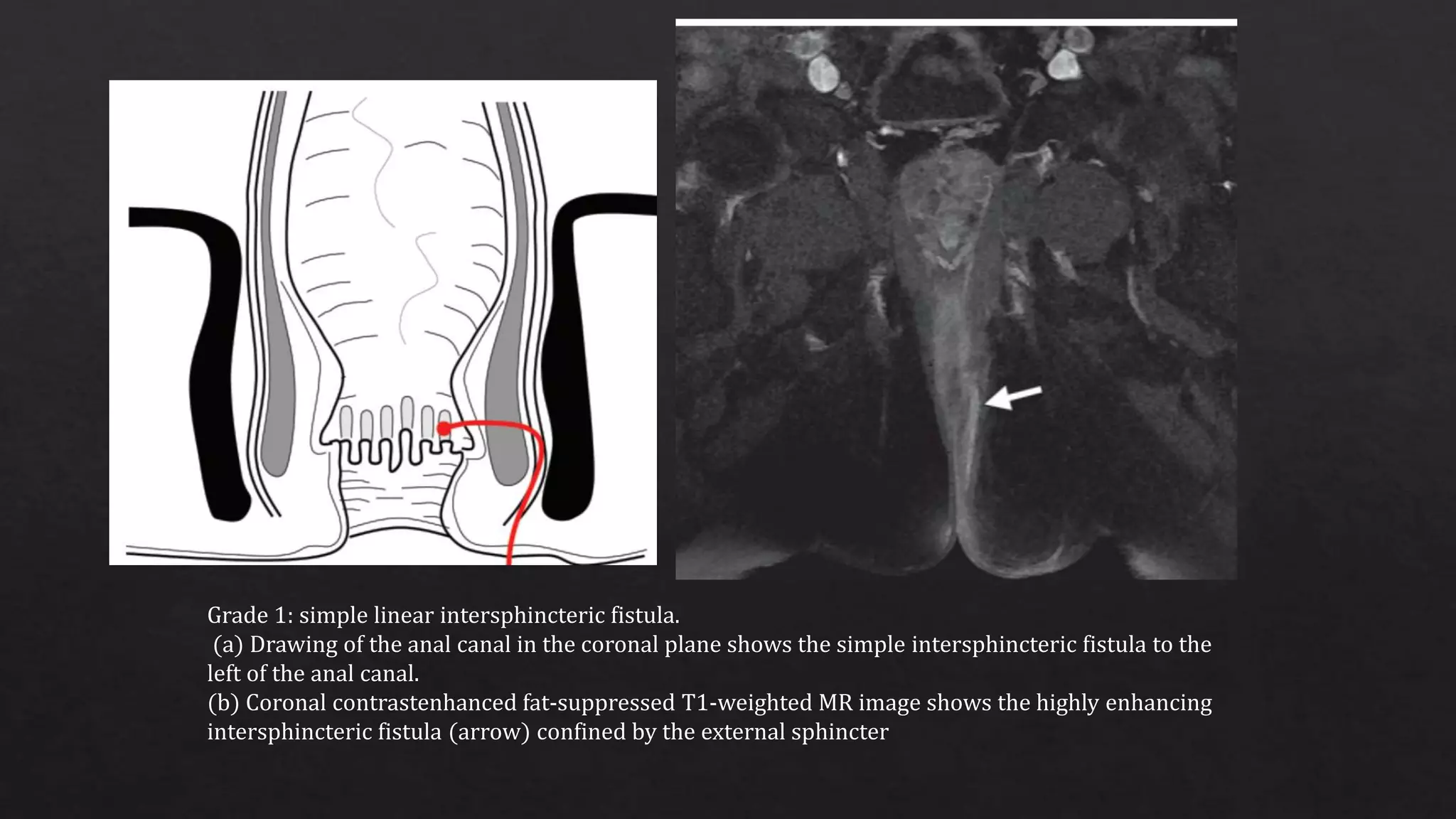 Radiological Imaging in perianal fistula | PPTX