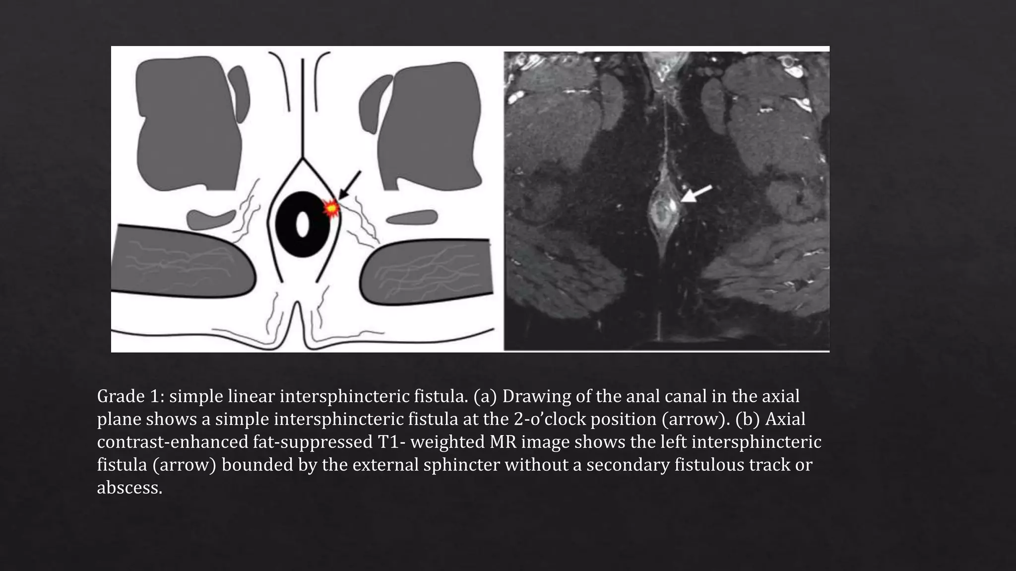 Radiological Imaging in perianal fistula | PPTX