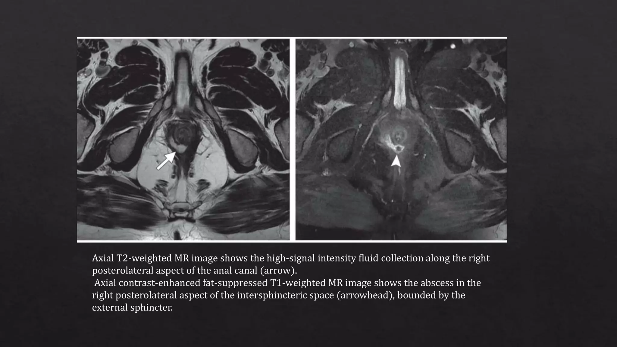 Radiological Imaging in perianal fistula | PPT | Free Download