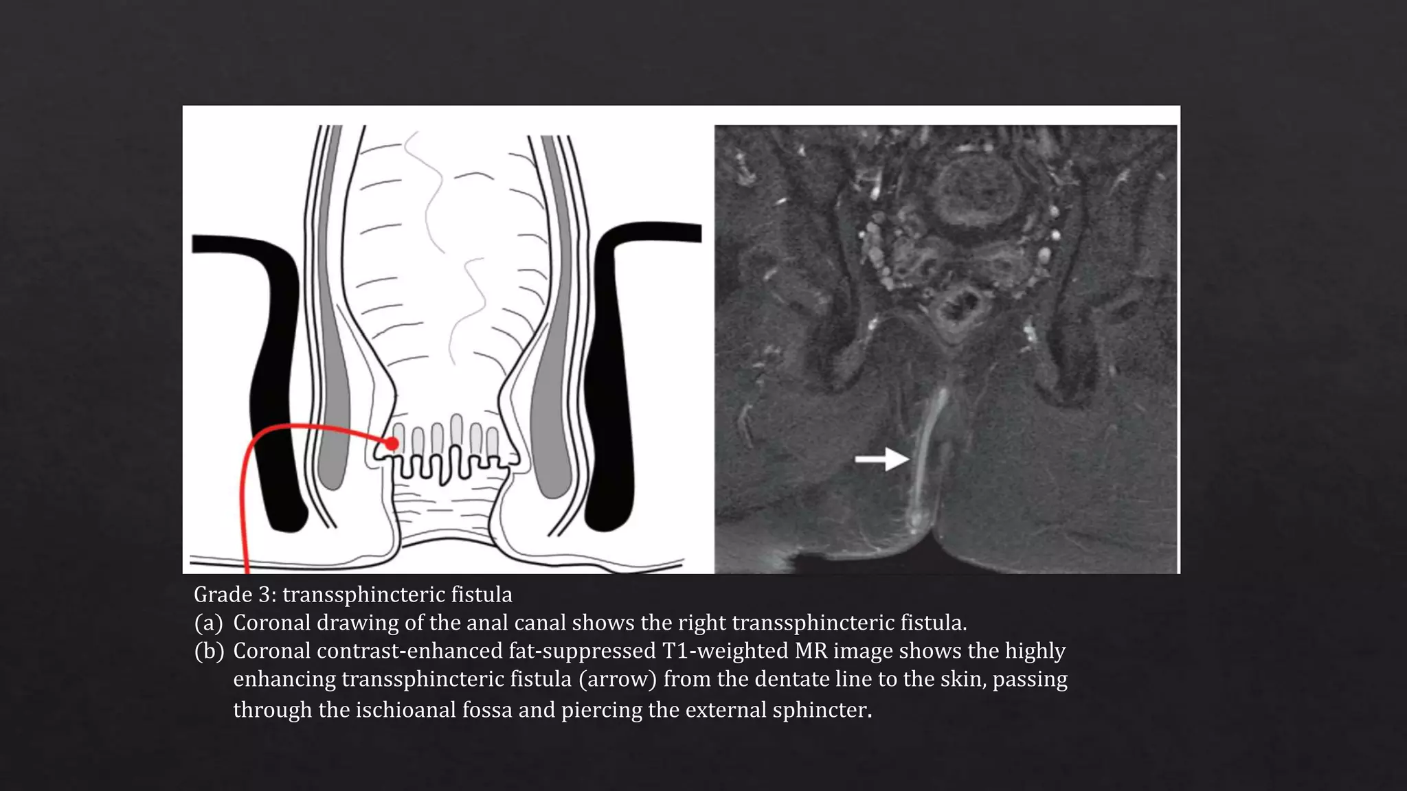 Radiological Imaging in perianal fistula | PPTX
