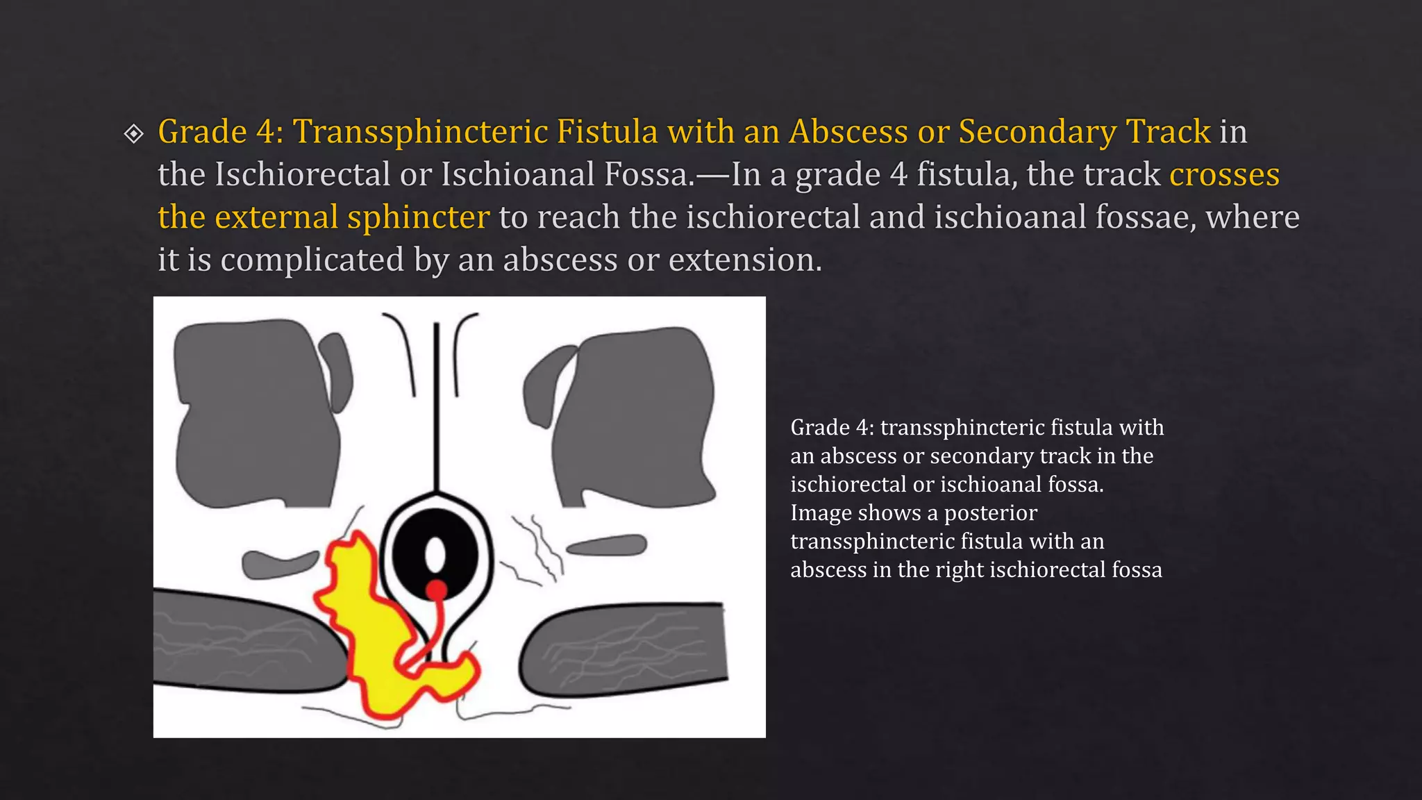 Radiological Imaging in perianal fistula | PPTX