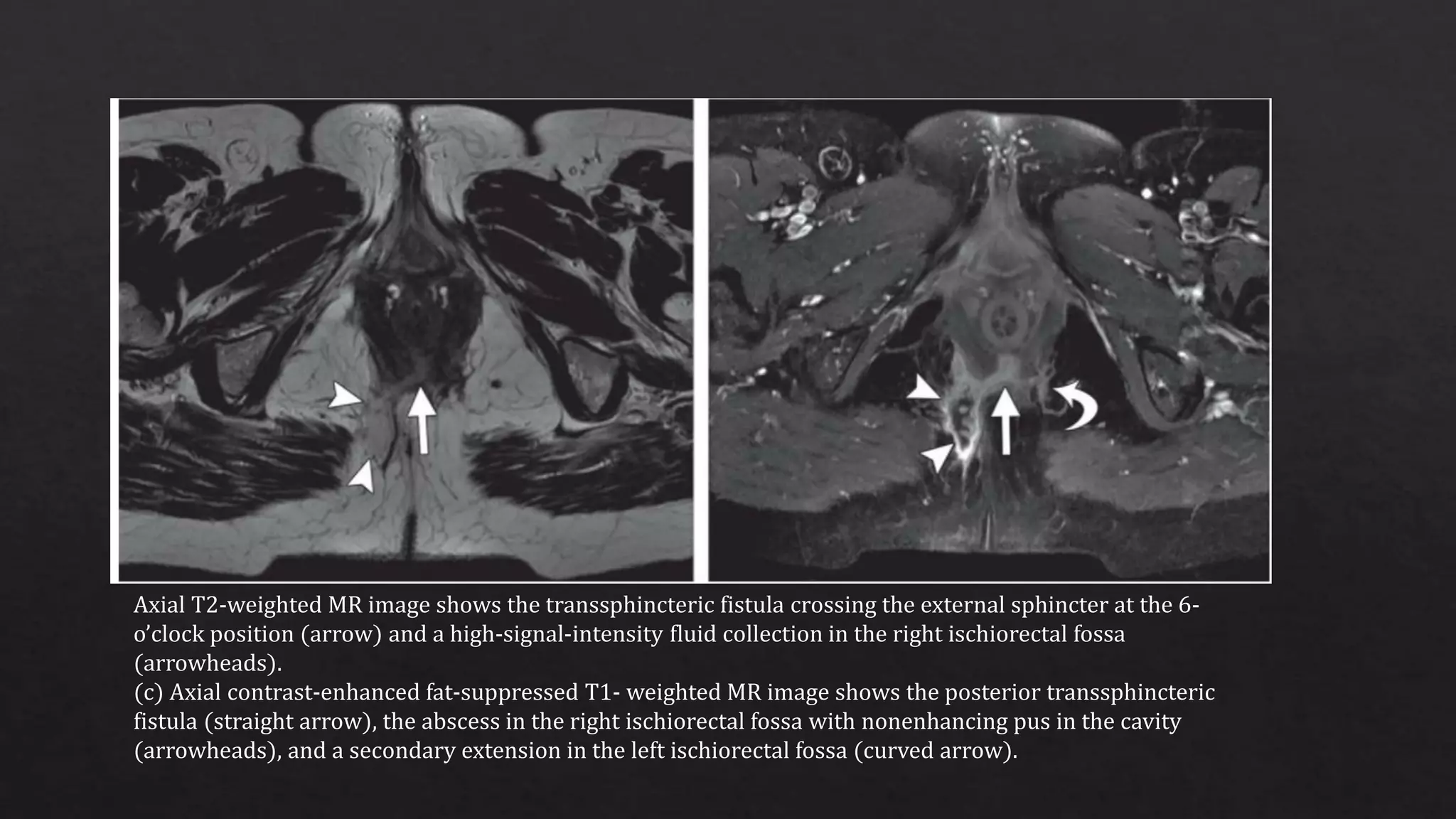 Radiological Imaging in perianal fistula | PPTX