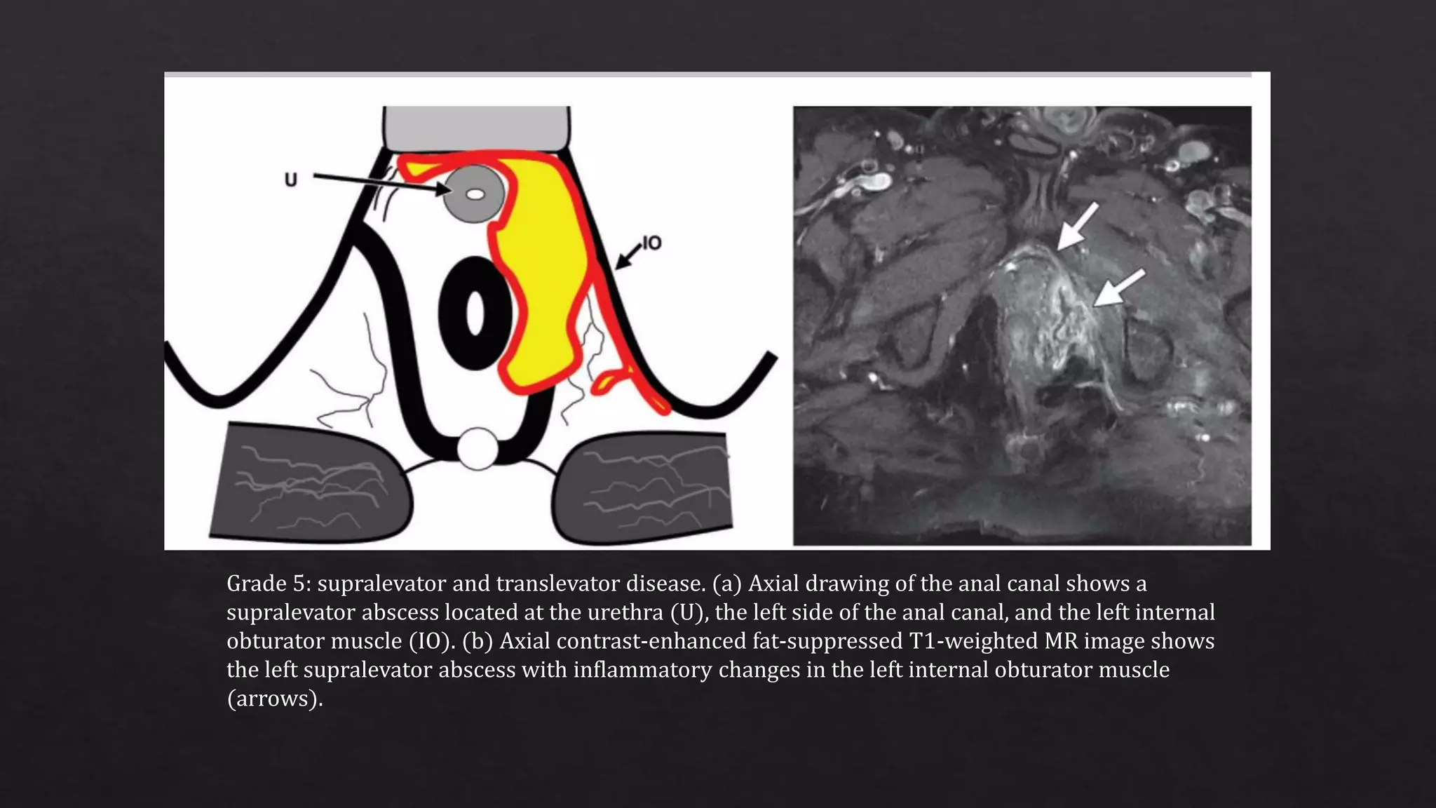 Radiological Imaging in perianal fistula | PPTX