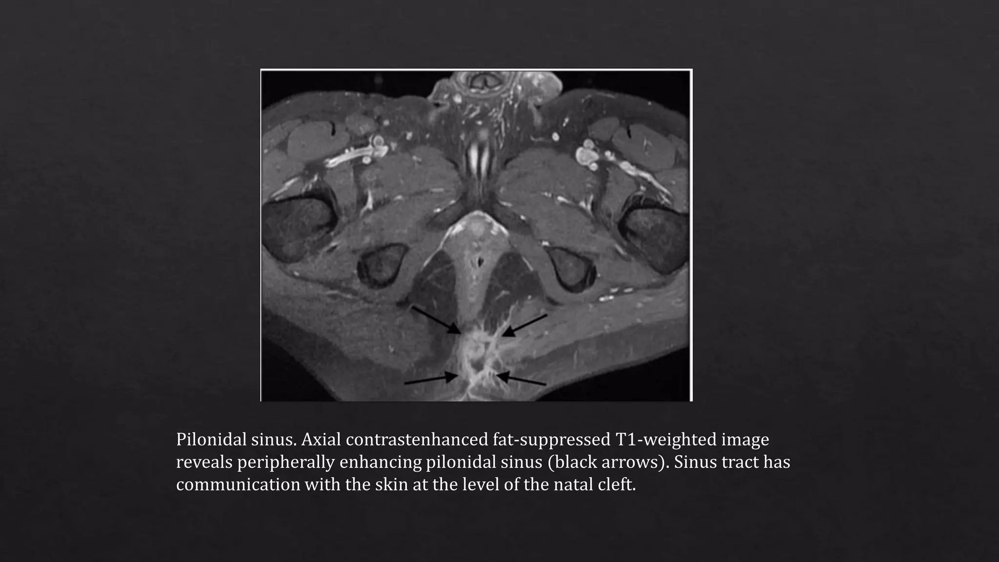 Radiological Imaging in perianal fistula | PPTX