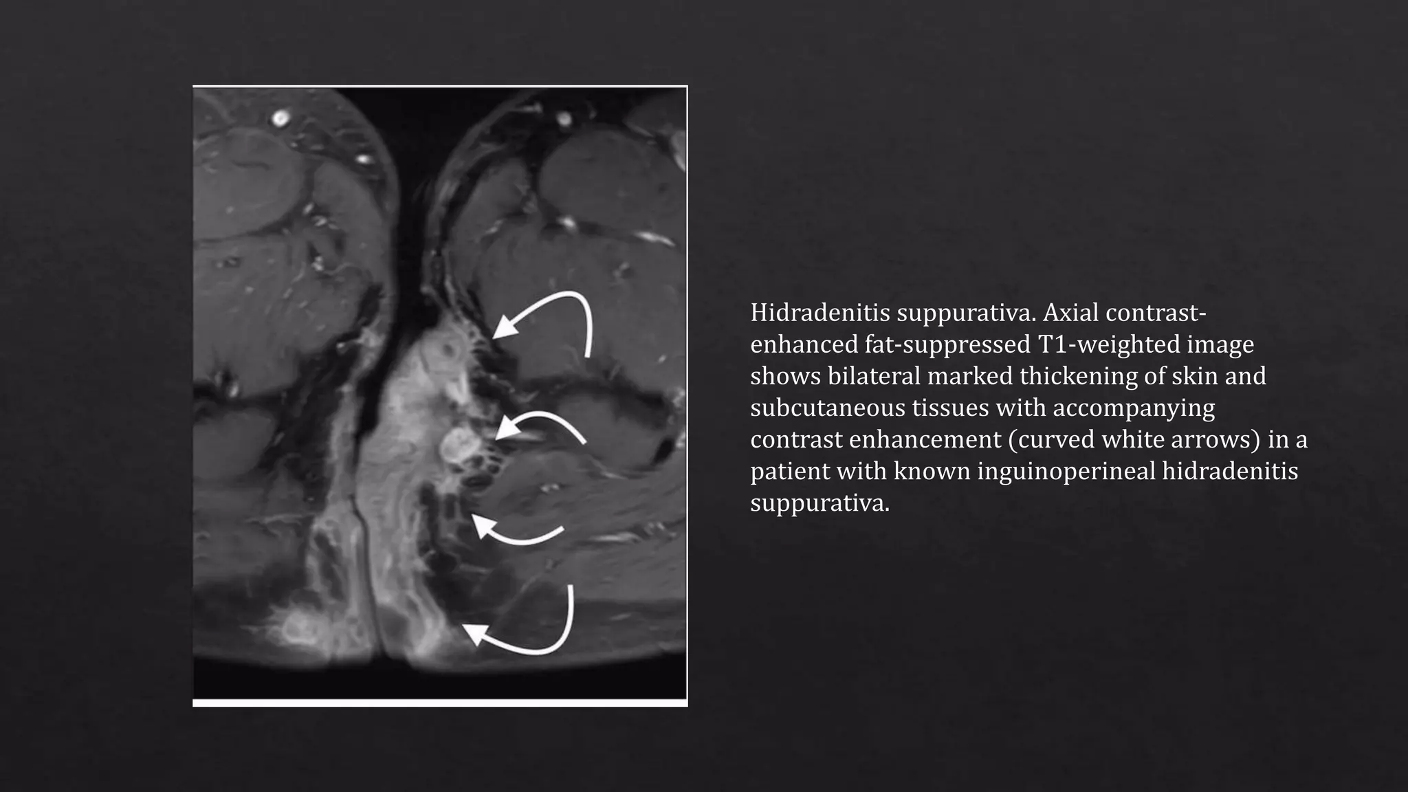 Radiological Imaging In Perianal Fistula Pptx