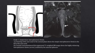 Radiological Imaging in perianal fistula | PPTX