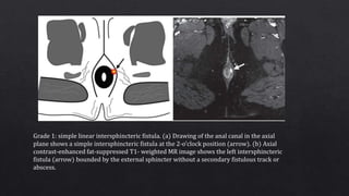 Radiological Imaging in perianal fistula | PPTX