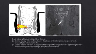 Radiological Imaging in perianal fistula | PPTX
