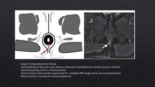 Radiological Imaging in perianal fistula | PPTX