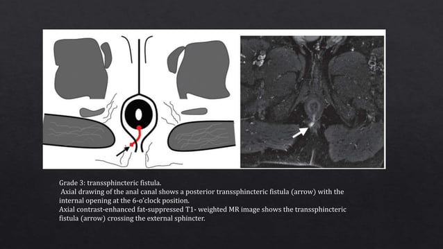Radiological Imaging in perianal fistula | PPTX