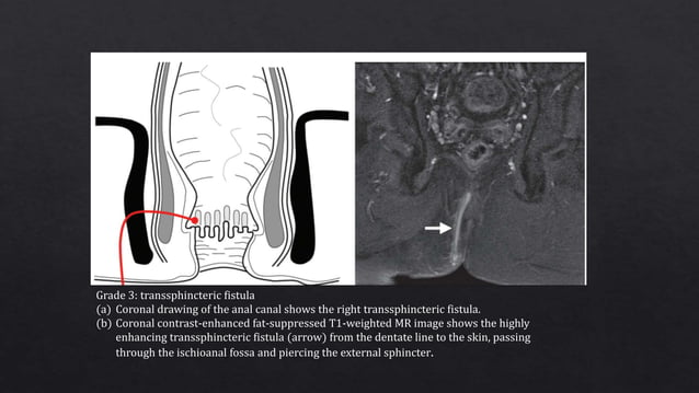 Radiological Imaging in perianal fistula | PPTX