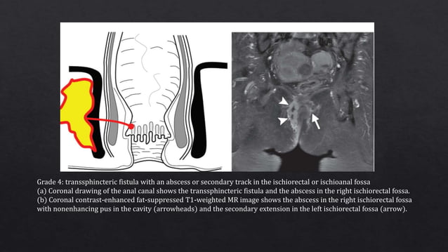 Radiological Imaging in perianal fistula | PPTX