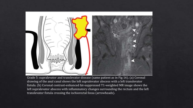 Radiological Imaging in perianal fistula | PPTX