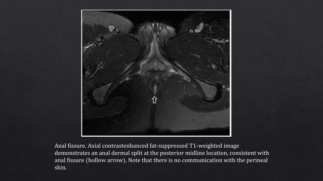 Radiological Imaging In Perianal Fistula Pptx