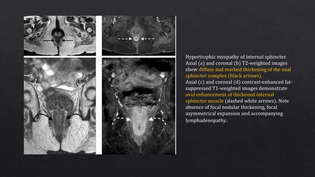 Radiological Imaging In Perianal Fistula Pptx