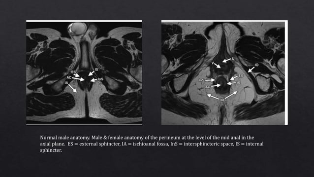 Radiological Imaging in perianal fistula | PPTX